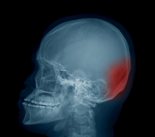 Memory Loss After Blow To Head Can Be Serious - Hoyt & Hoyt